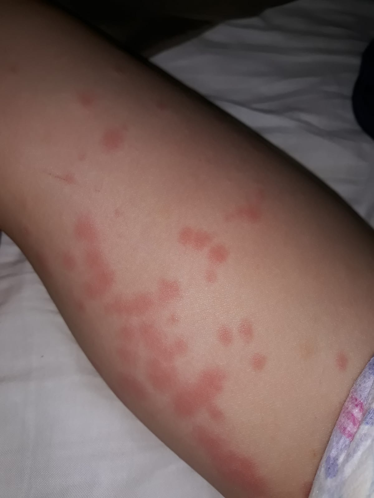 Na 1 dag weer een vrolijk spelend kind zonder jeukende bultjes ...